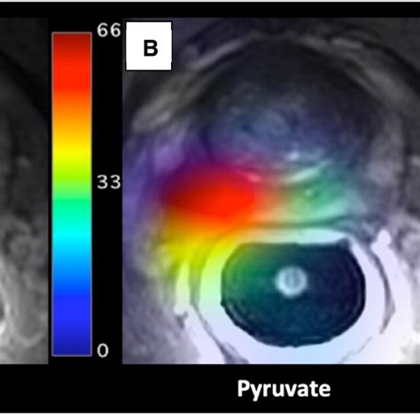 Hyperpolarised 1‐¹³c‐pyruvate‐mri Metabolite Maps In Mri‐ And Download Scientific Diagram