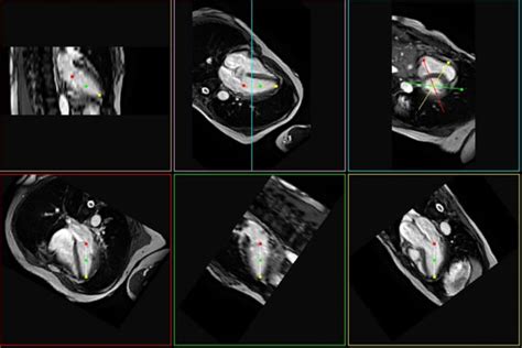 Example Of Knowledge Based 6 Plane Automatic Slice Alignment In A Patient Download Scientific