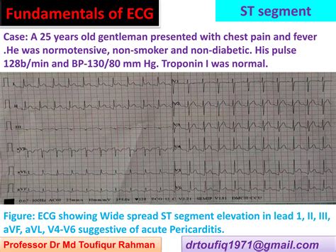Approach To A Patient With St Segment Abnormality In Ecg Ppt Approach To A Patient With St Segment Abnormality In Ecg Ppt