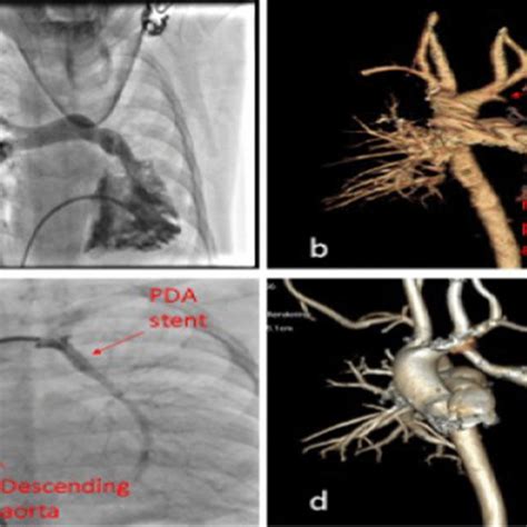 Absence Of The Left Pulmonary Artery In The Patient With No Remnant Of