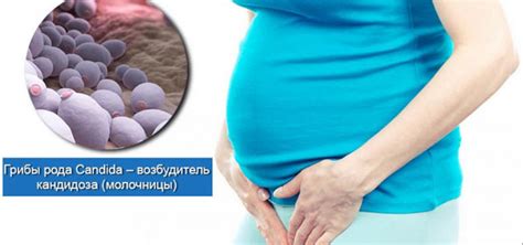 Вагинальный кандидоз симптомы причины диагностика и лечение