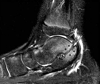 Tarsal Coalition Radsource