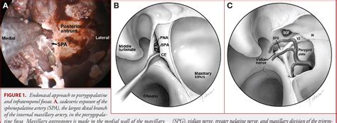 Pterygopalatine Fossa And Infratemporal Fossa