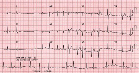 Case B16 Paroxysmal Atrial Fibrillation St Emlyns Ecg Library • St