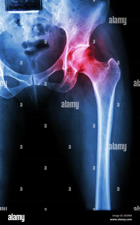 Arthritis At Hip Joint X Ray Pelvis And Hip Joint Gout