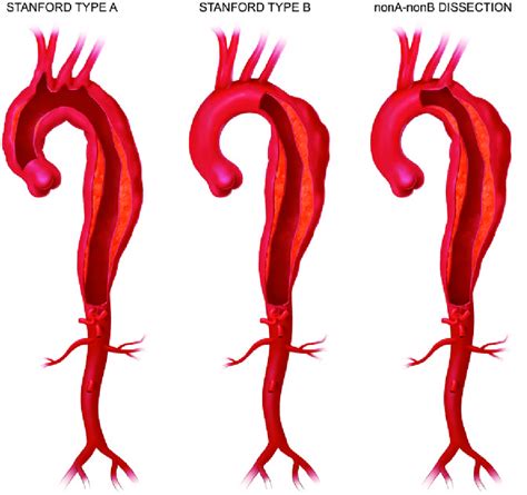 Aortic Dissection Wikipedia