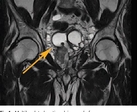 An Unusual Cystic Presentation Of Ductal Carcinoma Of The Prostate