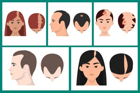 The 3 Different Conditions That Cause Your Hair To Fall Out And When