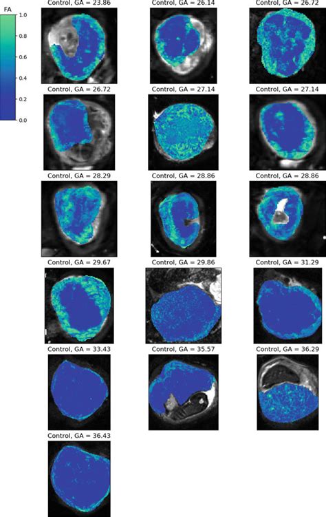 Fractional Anisotropy Maps For All Control Participants The Boundary