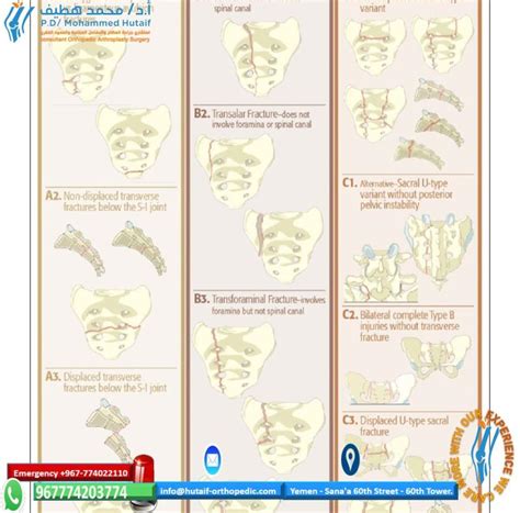 Ao Sacral Fracture Classification