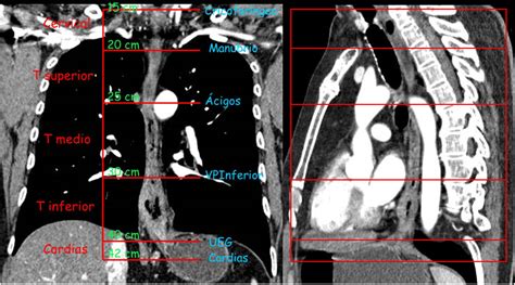 Cáncer De Esófago Revisión Actualizada Del Tnm Y De Sus Complicaciones