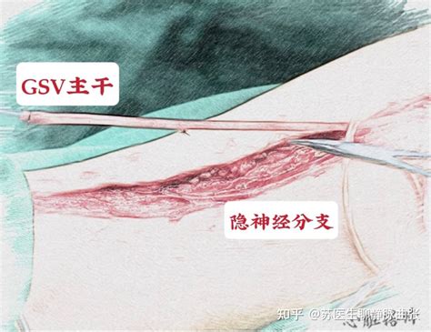 苏磊医生临床经验谈 ： 静脉曲张手术，如何减少神经损伤的并发症？ 知乎