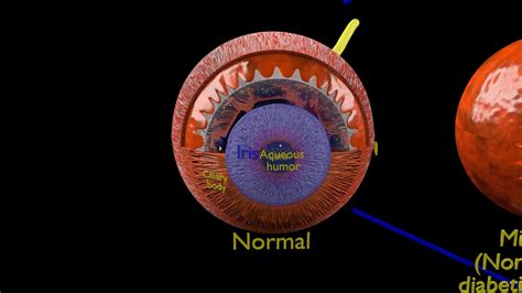 Stl File Diabetic Eye Diseases Model 👁️ ・template To Download And 3d Print・cults