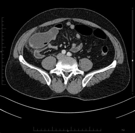 Computed Tomography Scan Of Abdomen And Pelvis Ct Scan Showing Large