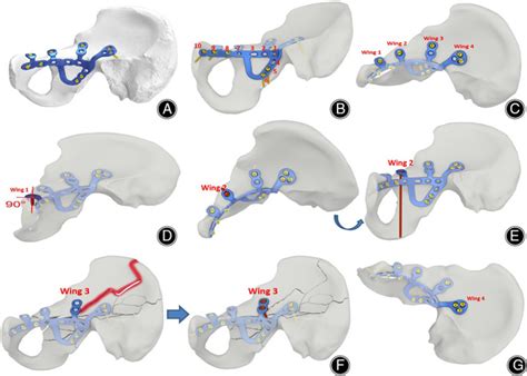 Design And Application Of An Acetabular Integrative Anatomic Plate A