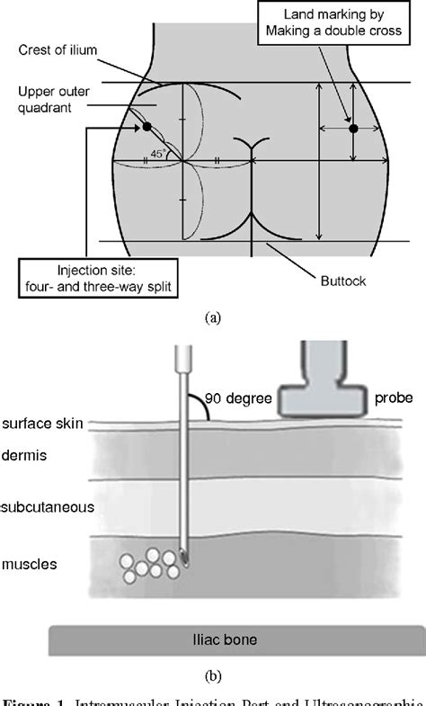 Diagram Of Intramuscular Injection Sites Three Intramuscular