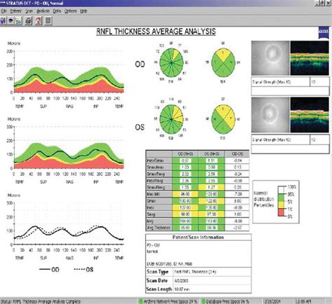 Oct In Glaucoma Diagnosis Detection And Screening Intechopen