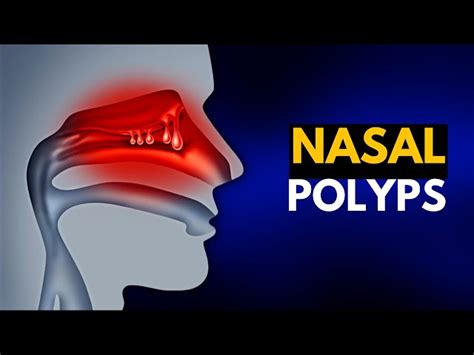 Nasal Polyp Causes Symptoms Diagnosis Treatment