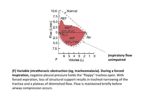 Tracheomalacia Flow Volume Loop