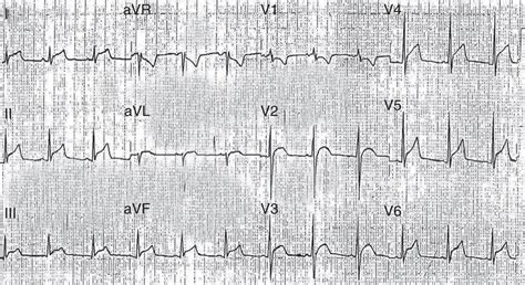 Pericarditis Pericardial Constriction And Pericardial Tamponade