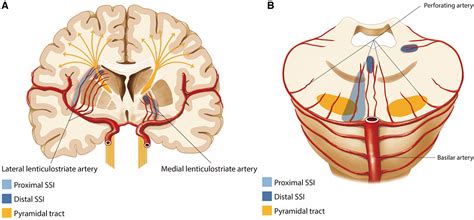 Lenticulostriate Arteries Stroke