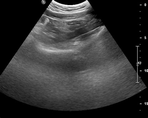 Radiopaedia Case Perforated Subhepatic Appendicitis Id 83963 Study