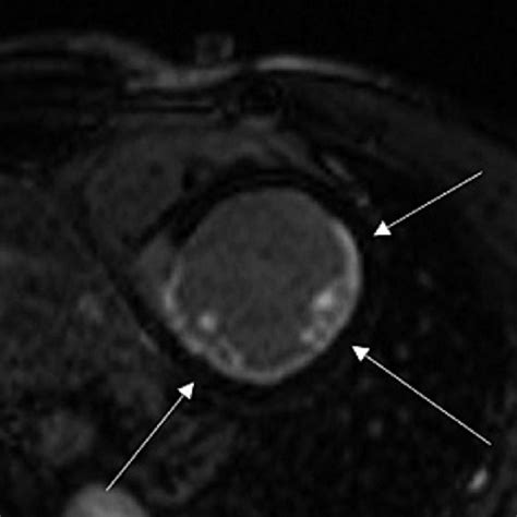 Subendocardial Infarction Of The Inferoseptal Inferior Inferolateral