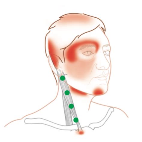 Trigger Point Release For Sternocleidomastoid Scm Artofit