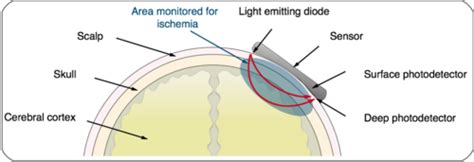 Advanced Intraoperative Monitoring And Equipment Flashcards Quizlet