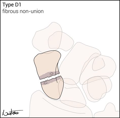 Radiopaedia Case Herbert And Fisher Classification Of Scaphoid