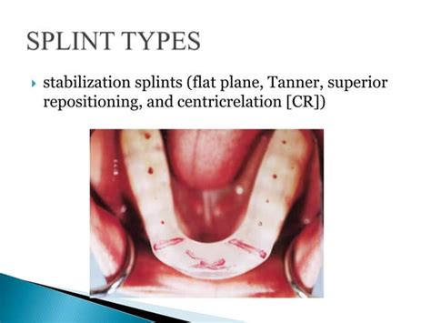 Splint Therapy For Tmj Disc Displacement PPTX Physical Therapy Wellness