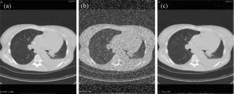 Denoising Results Of Proposed Mtni Sdsnr Technique For Ct Scan Image