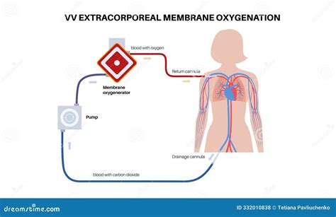 Extracorporeal Membrane Oxygenation Stock Illustration Illustration Of Cannula Heart 332010838