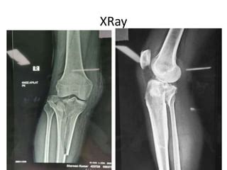 Proximal Tibia Fracture PPT