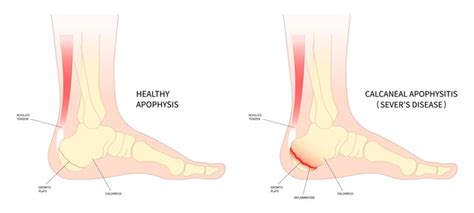 What Is Severs Disease Calcaneal Apophysitis And How Can It Be Treate