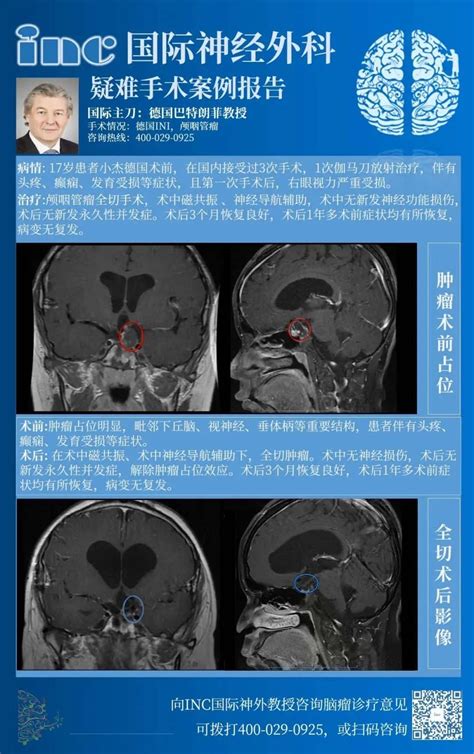 颅咽管瘤复发怎么办INC国际神经外科巴特朗菲教授颅咽管瘤案例交流 INC 国际神经外科医生集团
