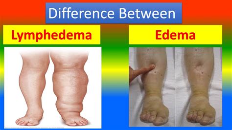 Difference Between Lymphedema And Edema Youtube