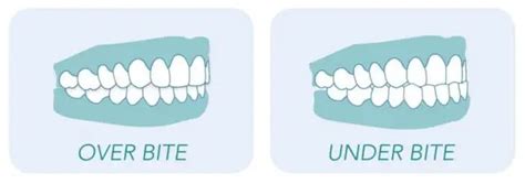 Whats The Difference Between Underbite Vs Overbite
