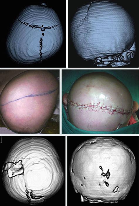 3 A F One Case Of Isolated Single Suture Lambdoid Synostosis Download Scientific Diagram