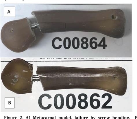 Figure 1 From Comparative Bending Strength Of Metacarpal Neck Fractures