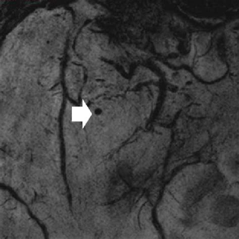 A 47 Year Old Male With Sudden Onset Of Severe Headache Tof Mra And Download Scientific