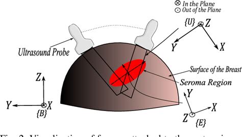 Figure 2 From Robot Assisted Breast Ultrasound Scanning Using Geometrical Analysis Of The Seroma