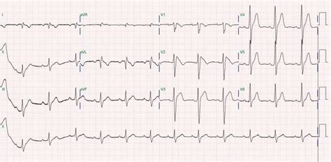 Type 1 Brugada Pattern Coved Type St Segment Elevation In The V1 To V2