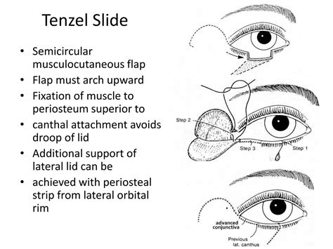 Lower Eyelid Reconstruction Ppt