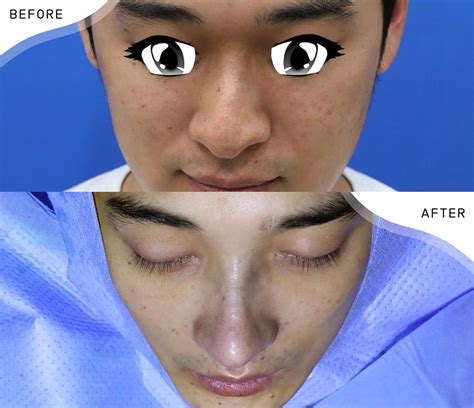 코리아이비인후과 휜 코 그리고 매부리코 교정 심각한 비중격만곡증 수술 비밸브 수술과 비염수술