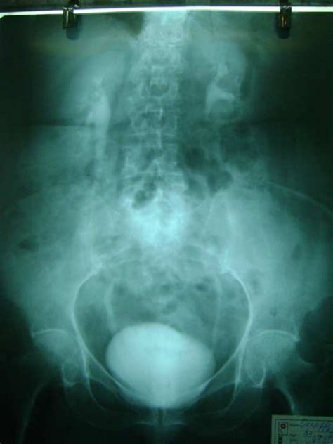Buccal Mucosa Ureteroplasty For The Treatment Of Complex Ureteric Injury PMC