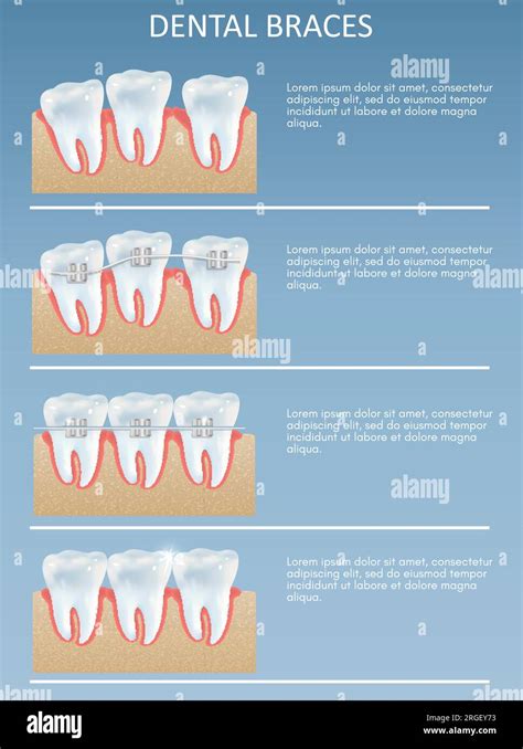 Dental Braces Infographic Brochure Orthodontic Dentistry Poster Stock Vector Image And Art Alamy