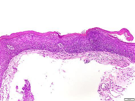 Leukoplakia Tongue Histology