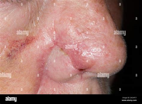 Close Up Of Removed Excised Basal Cell Carcinoma Bcc Or Rodent