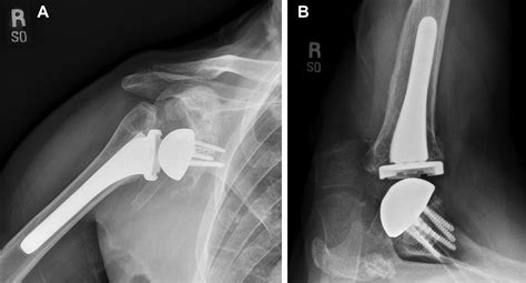 Reverse Total Shoulder Arthroplasty After Iatrogenic Axillary Artery